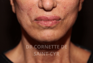 Fil tenseur visage avant après - Photo résultat cou visage - Chirurgie ...