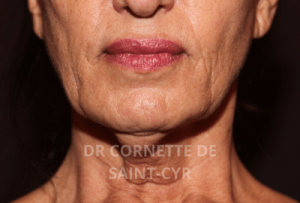 Fil tenseur visage avant après - Photo résultat cou visage - Chirurgie ...