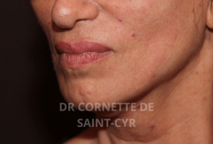 Fil tenseur visage avant après - Photo résultat cou visage - Chirurgie ...